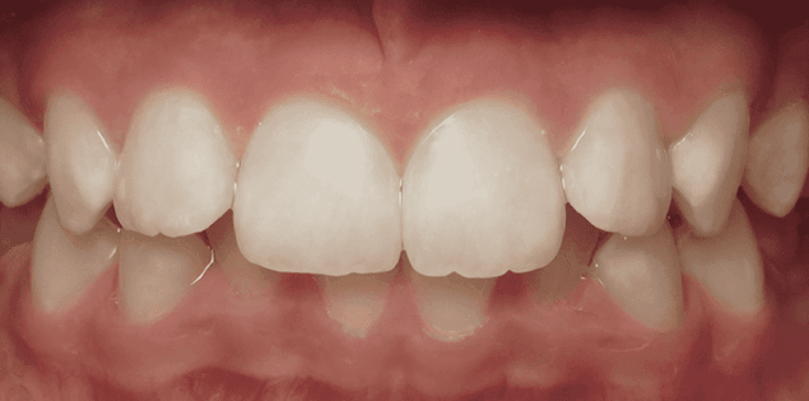 Czym jest zgryz głęboki i czy wpływa na wygląd?